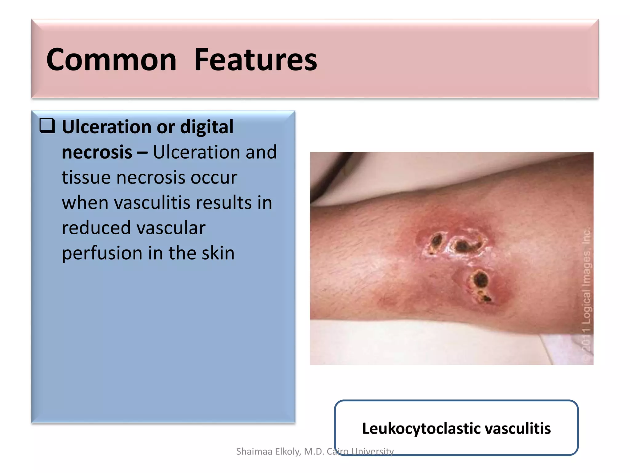 Cutaneous vasculitis | PPTX
