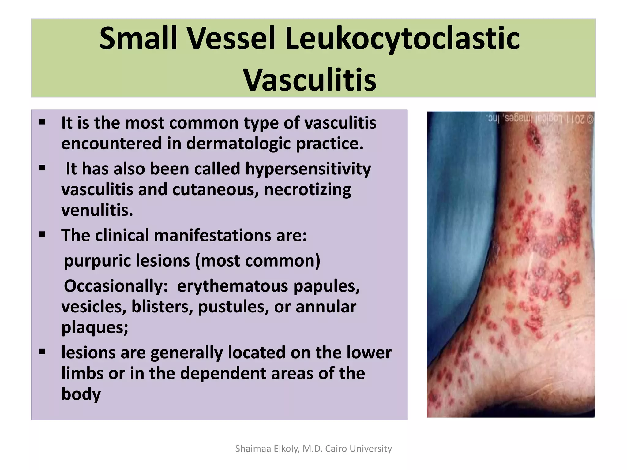 Cutaneous vasculitis | PPTX