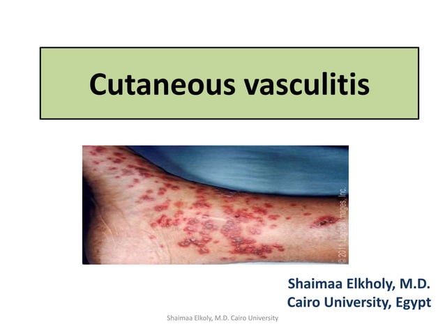 Cutaneous vasculitis | PPTX