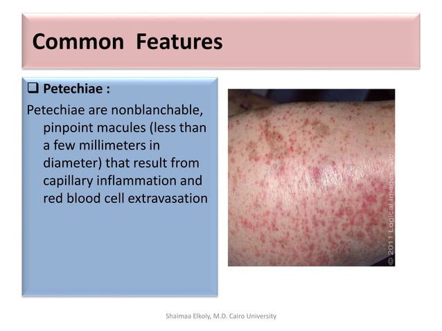 Cutaneous Vasculitis Ppt