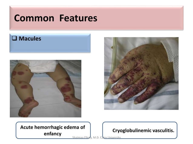 Cutaneous vasculitis | PPTX