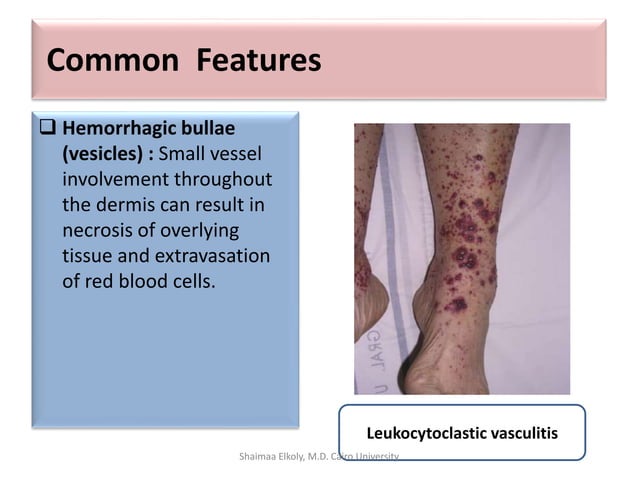 Cutaneous vasculitis | PPTX