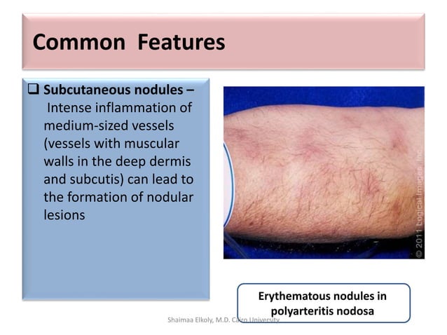 Cutaneous vasculitis | PPTX