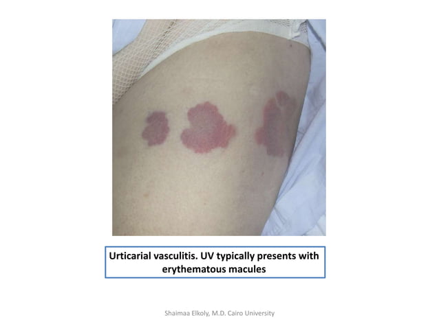 Cutaneous vasculitis | PPTX