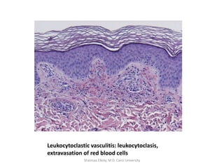 Urticarial Vasculitis Histology