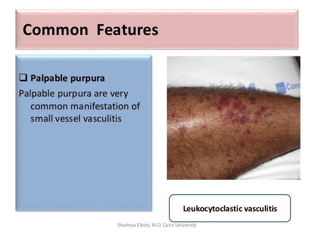 Cutaneous Vasculitis