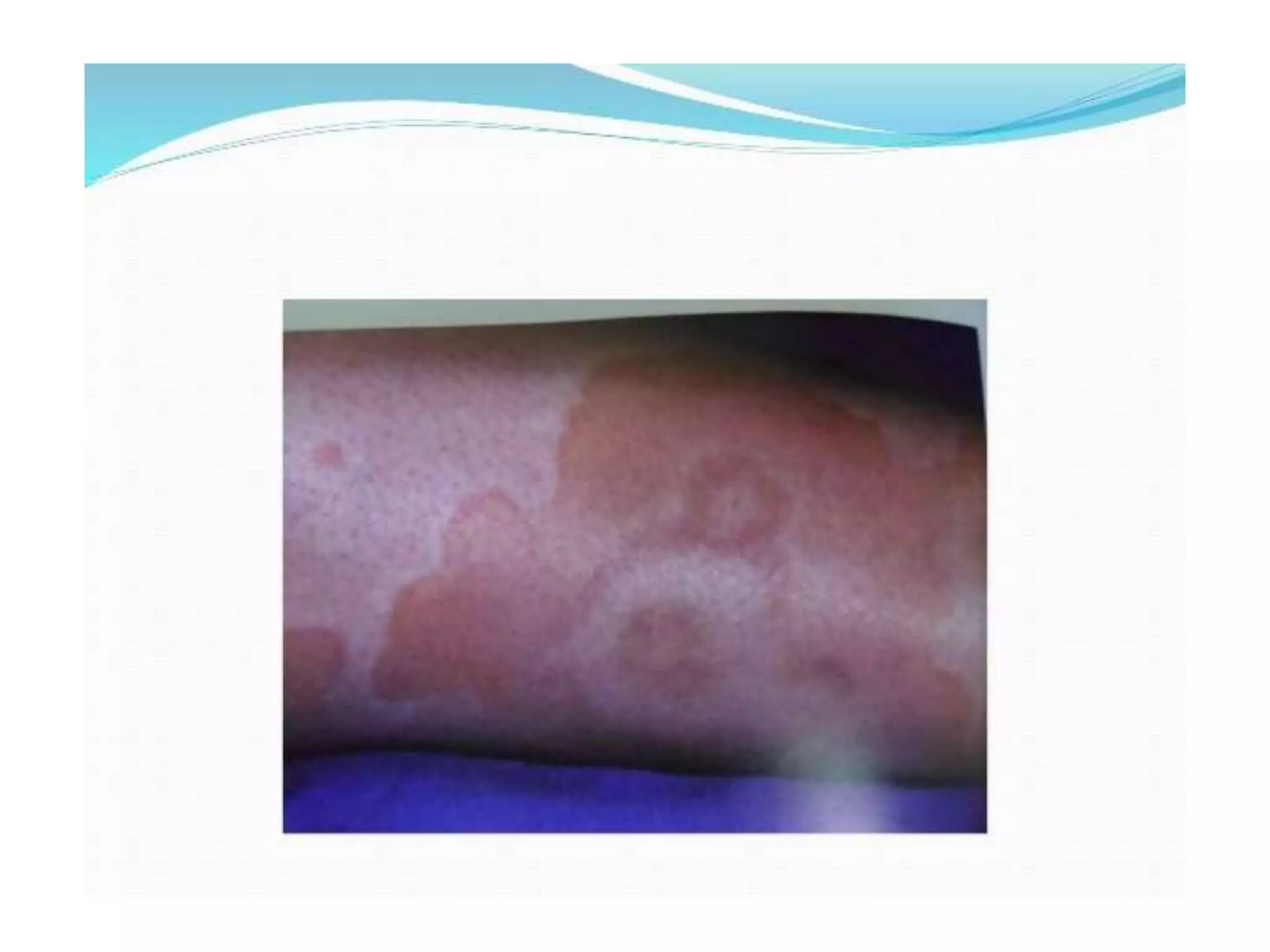 Cutaneous vasculitis | PPT