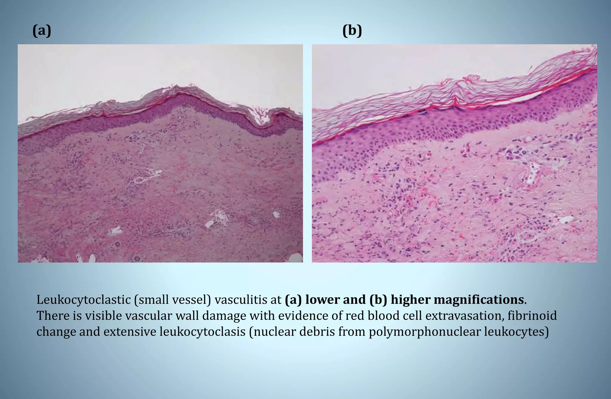Cutaneous vasculitis by dr maria | PPTX