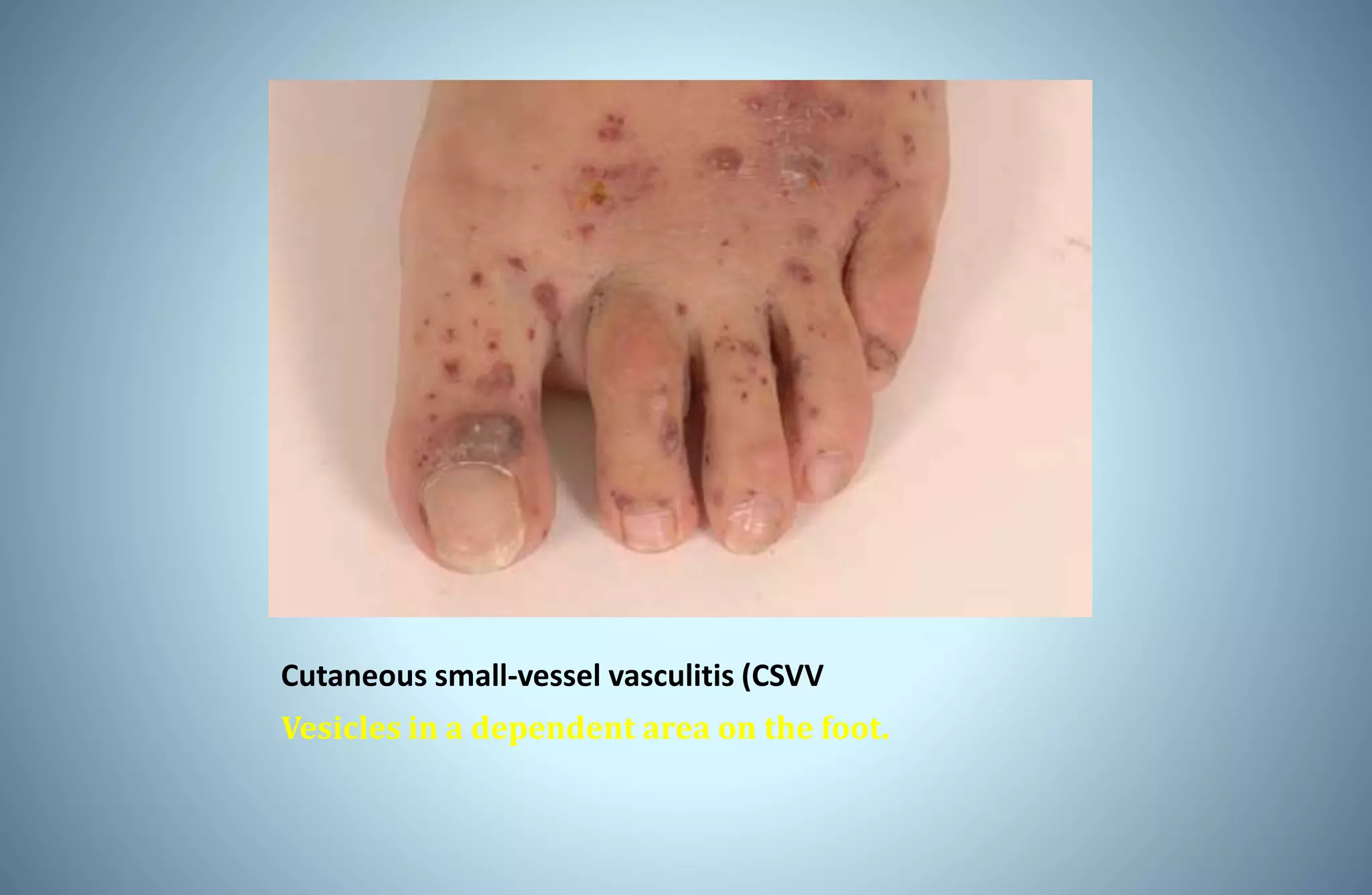 Cutaneous vasculitis by dr maria | PPTX