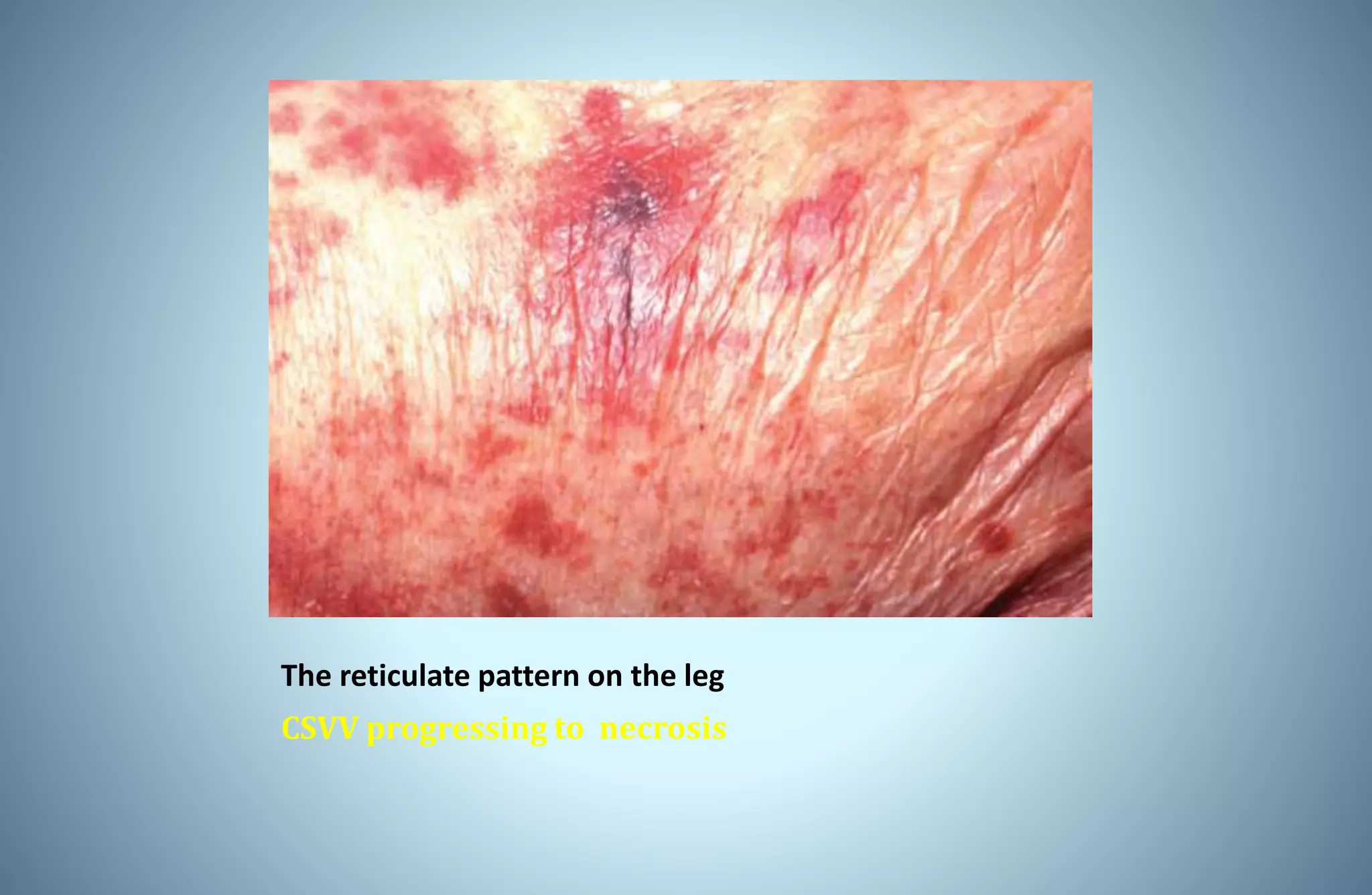Cutaneous vasculitis by dr maria | PPTX