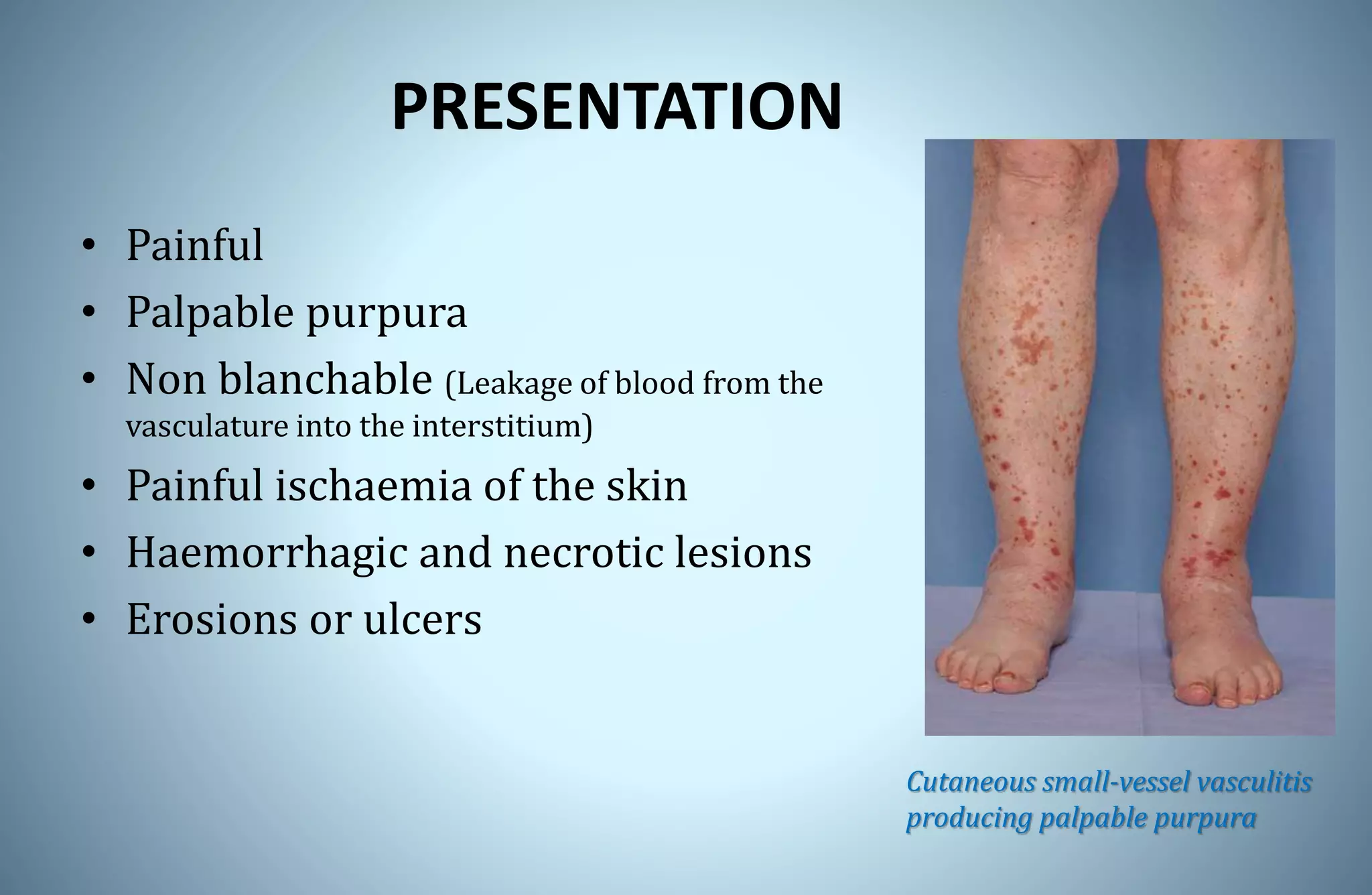 Cutaneous vasculitis by dr maria | PPTX