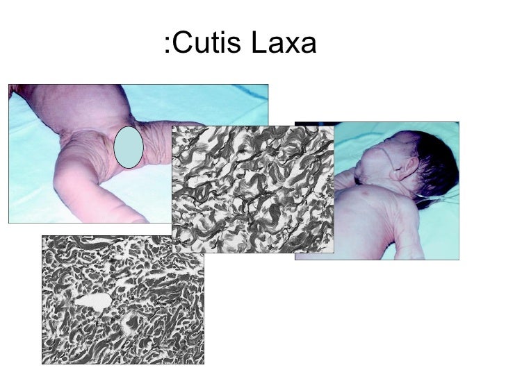 Cutis Laxa