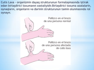 Cutis laxa xəstəliyi | PPT