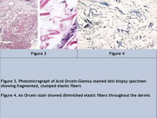 Cutis laxa xəstəliyi | PPT