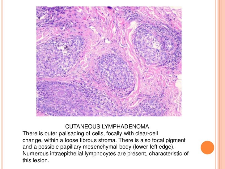 Cutaneous pseudolymphomas
