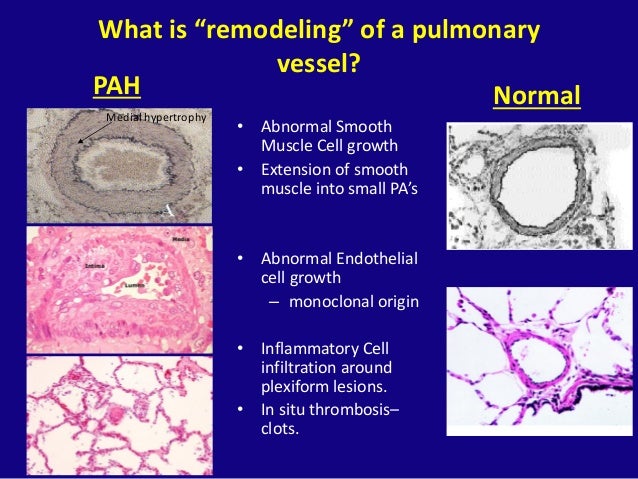Pulmonary Arterial Hypertension Overview for Scleroderma Patients