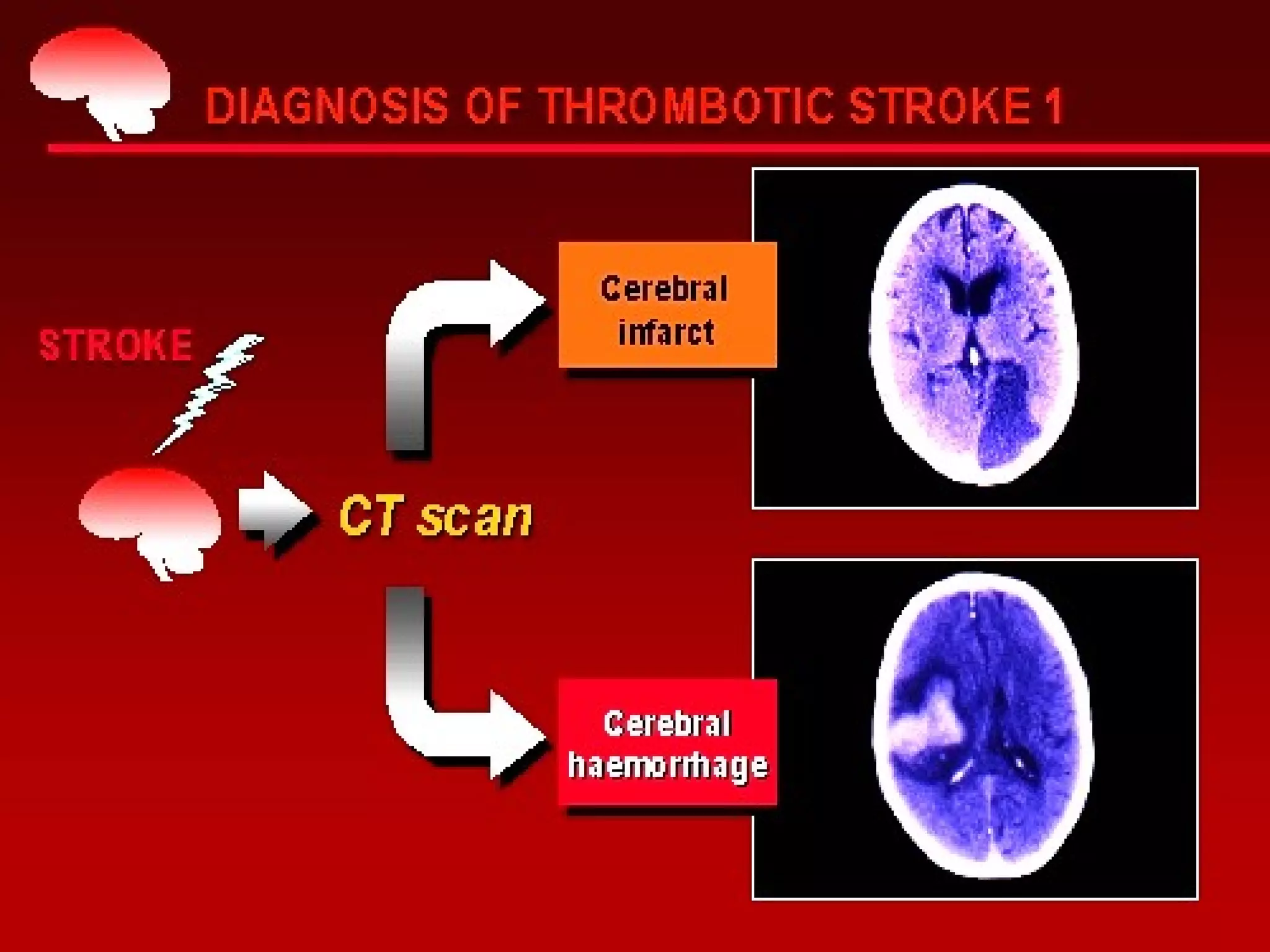 Cerebro Vascular Accident (CVA) | PPT