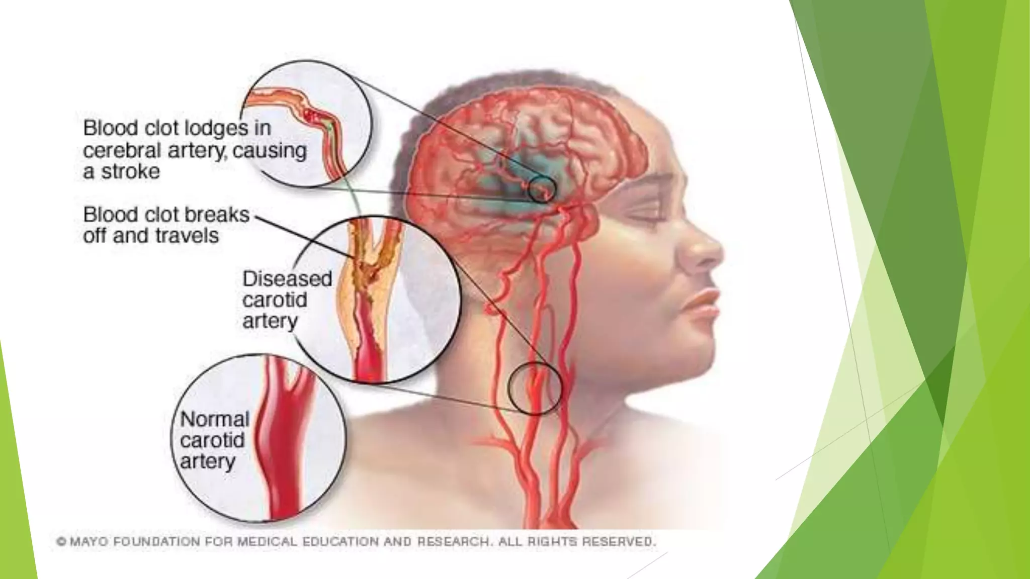 Cerebrovascular accident | PPTX
