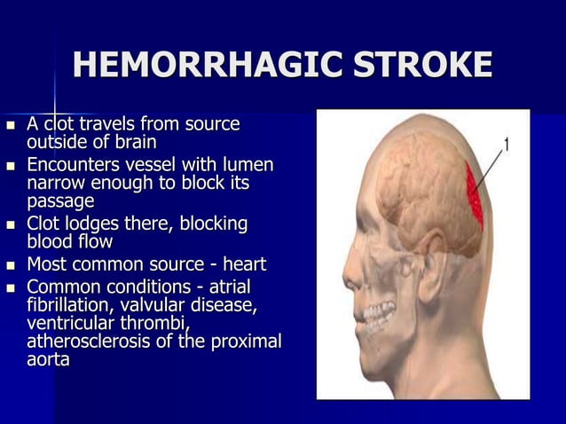 cerebrovascular Accident cva cva cva.ppt | Heart and Cardiovascular ...