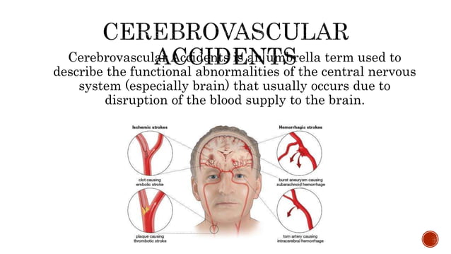 cerebrovascular accidents - types, causes and its management | PPT