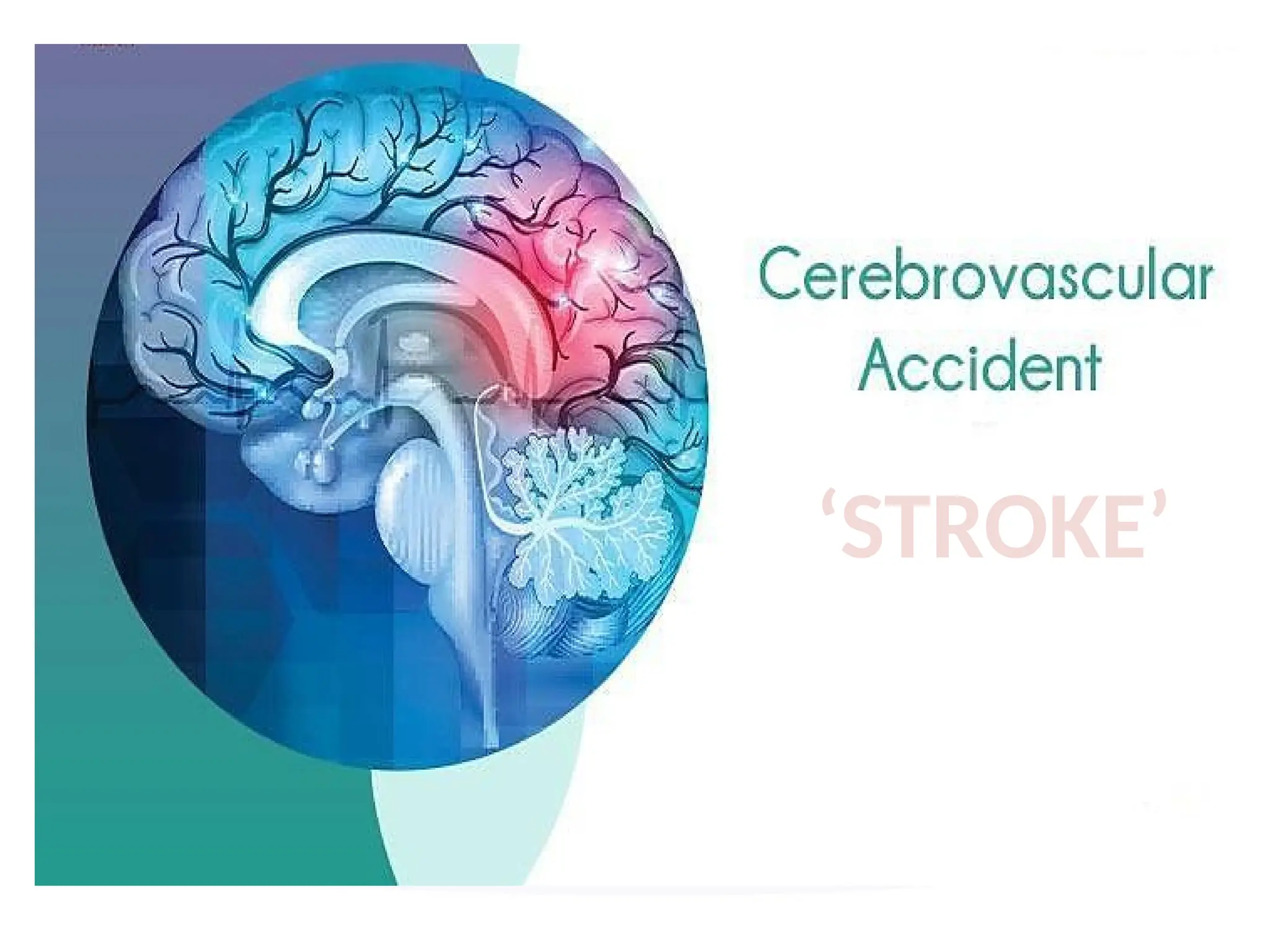 CVA - Cerebrovascular Accident / Stroke | PPTX