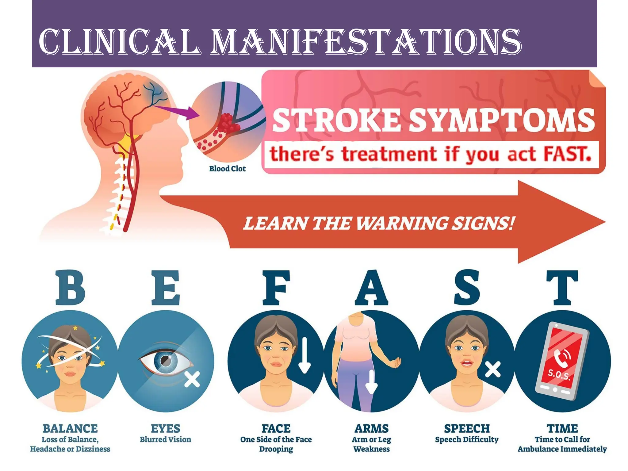 CVA - Cerebrovascular Accident / Stroke | PPTX