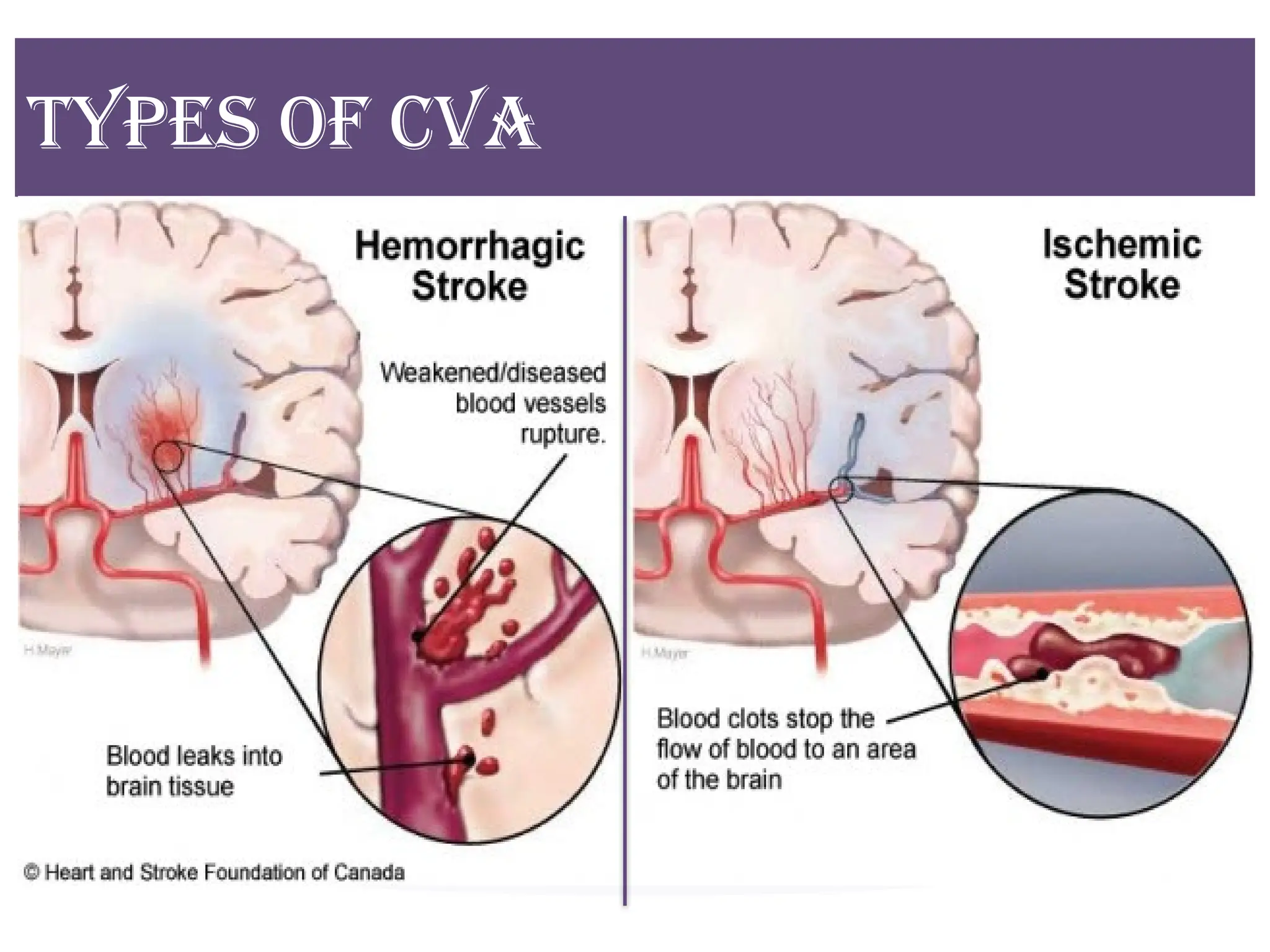 CVA - Cerebrovascular Accident / Stroke | PPTX | Blood Disorders | Diseases and Conditions