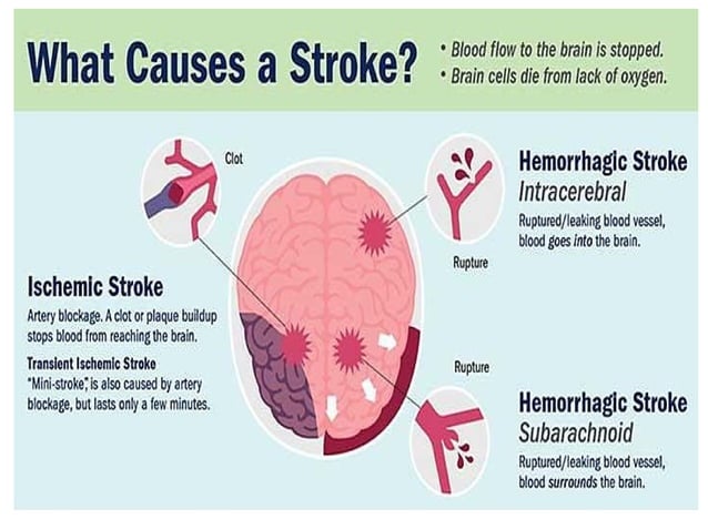 CVA - Cerebrovascular Accident / Stroke | PPTX | Blood Disorders | Diseases and Conditions