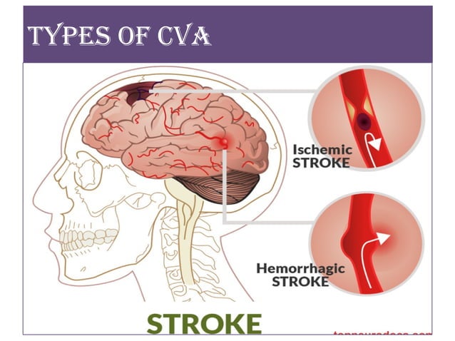 CVA - Cerebrovascular Accident / Stroke | PPT