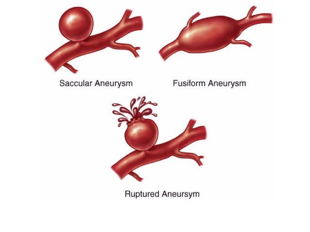 Cerebrovascular accident anatomy details.pptx