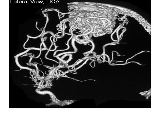 Cerebrovascular accident anatomy details.pptx