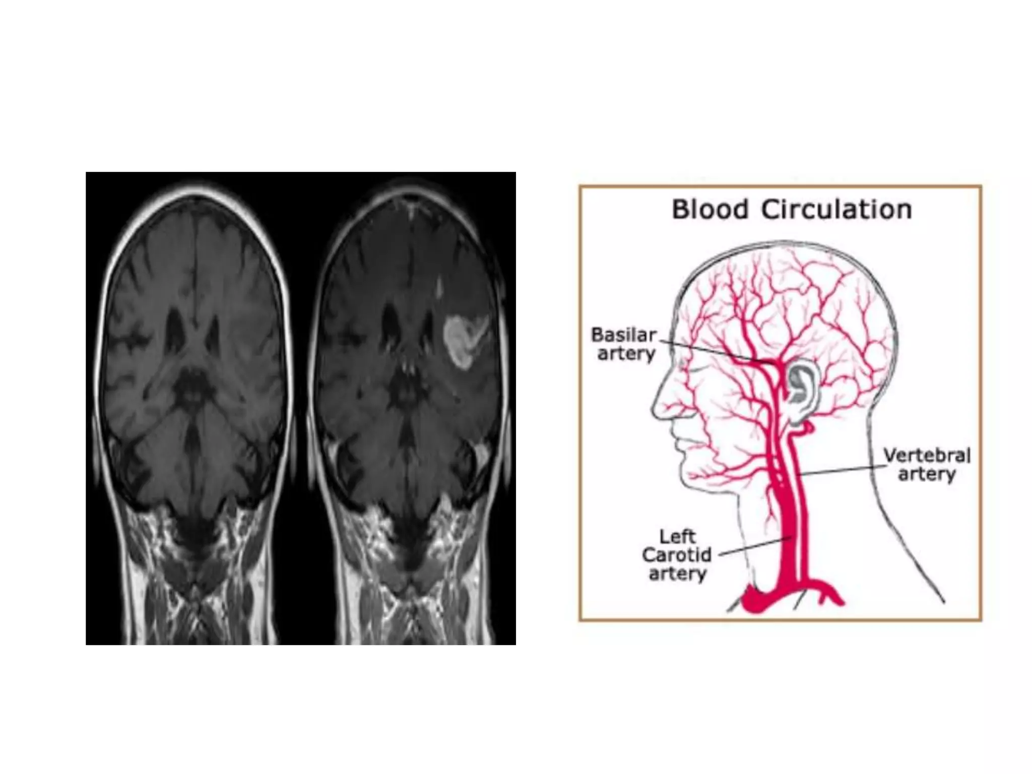 Cva case stroke | PPTX