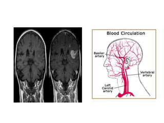 Cva case stroke | PPT