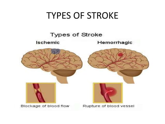 Cva case stroke | PPT