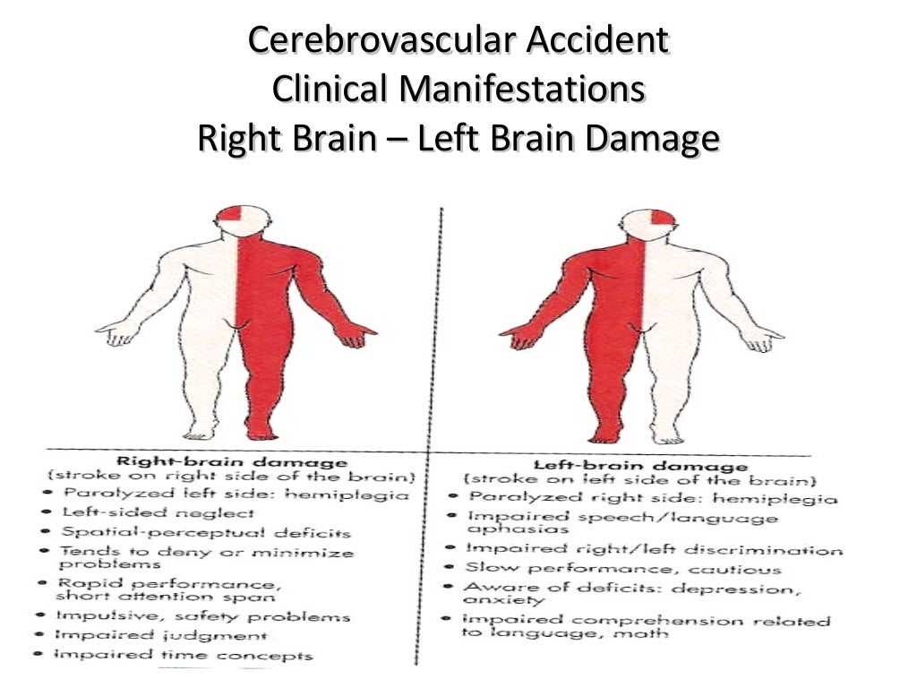 Cva (cerebro vascular accident)