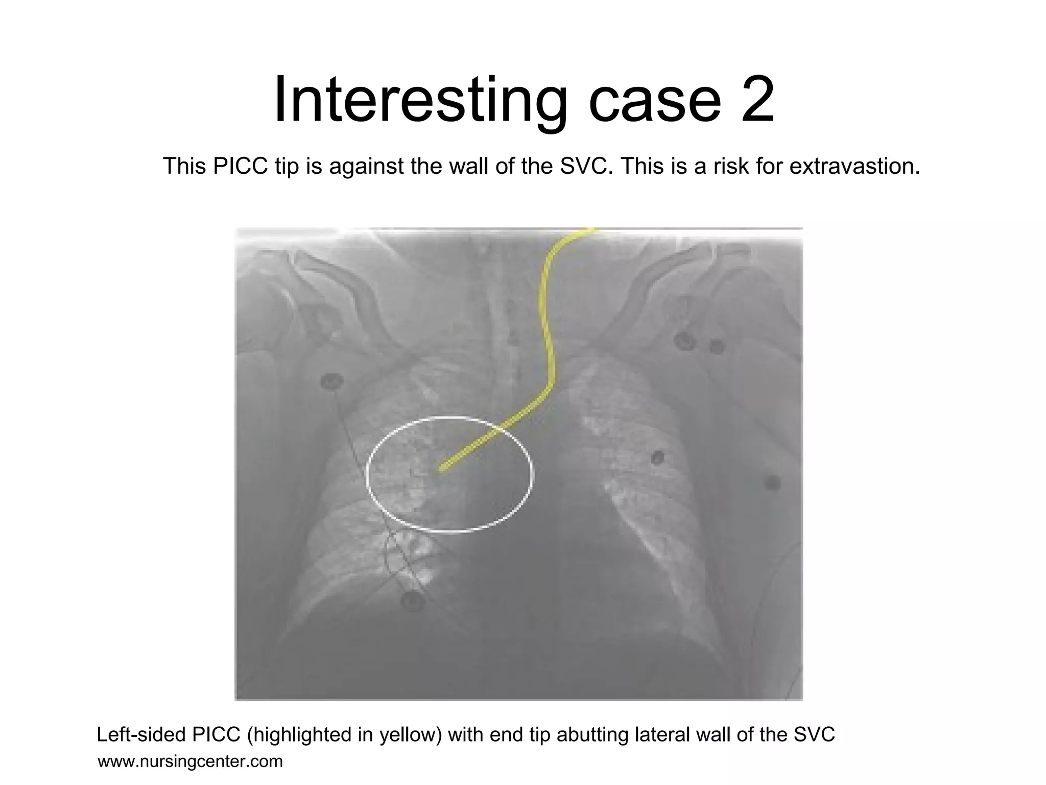 CVAD Management, Care and Maintenance (Radiology Nursing) | PPT