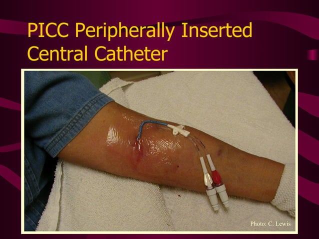 Central Venous Access Devices Made Incredibly Easy!