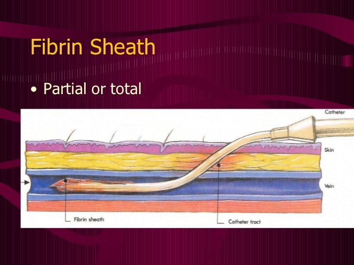 Central Venous Access Devices Made Incredibly Easy!