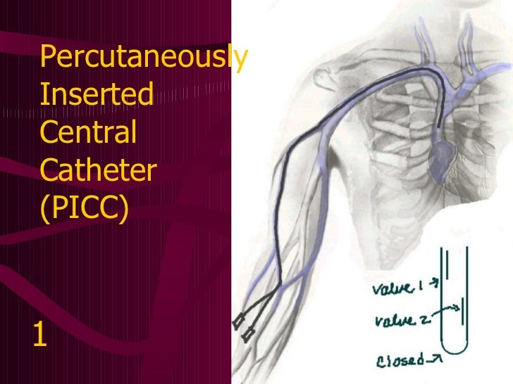 Central Venous Access Devices Made Incredibly Easy!