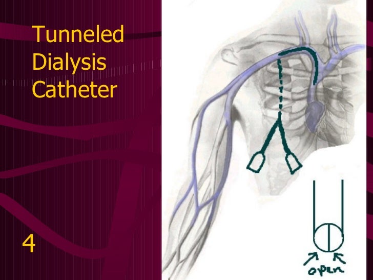 Types Of Tunneled Dialysis Catheters