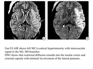 MRI in CVA | PPTX