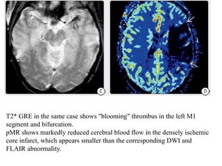 MRI in CVA | PPTX