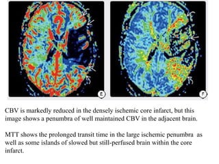 MRI in CVA | PPTX