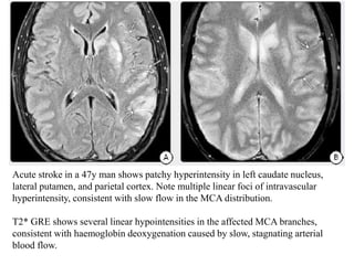 MRI in CVA | PPTX