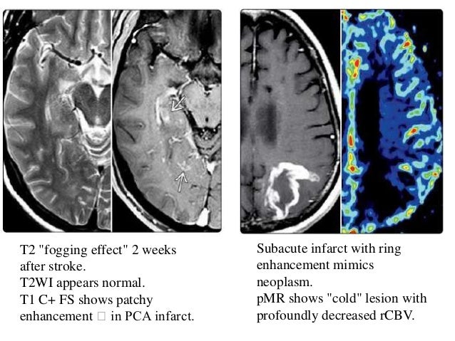 MRI in CVA