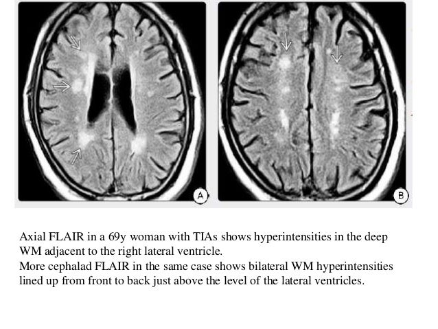 MRI in CVA