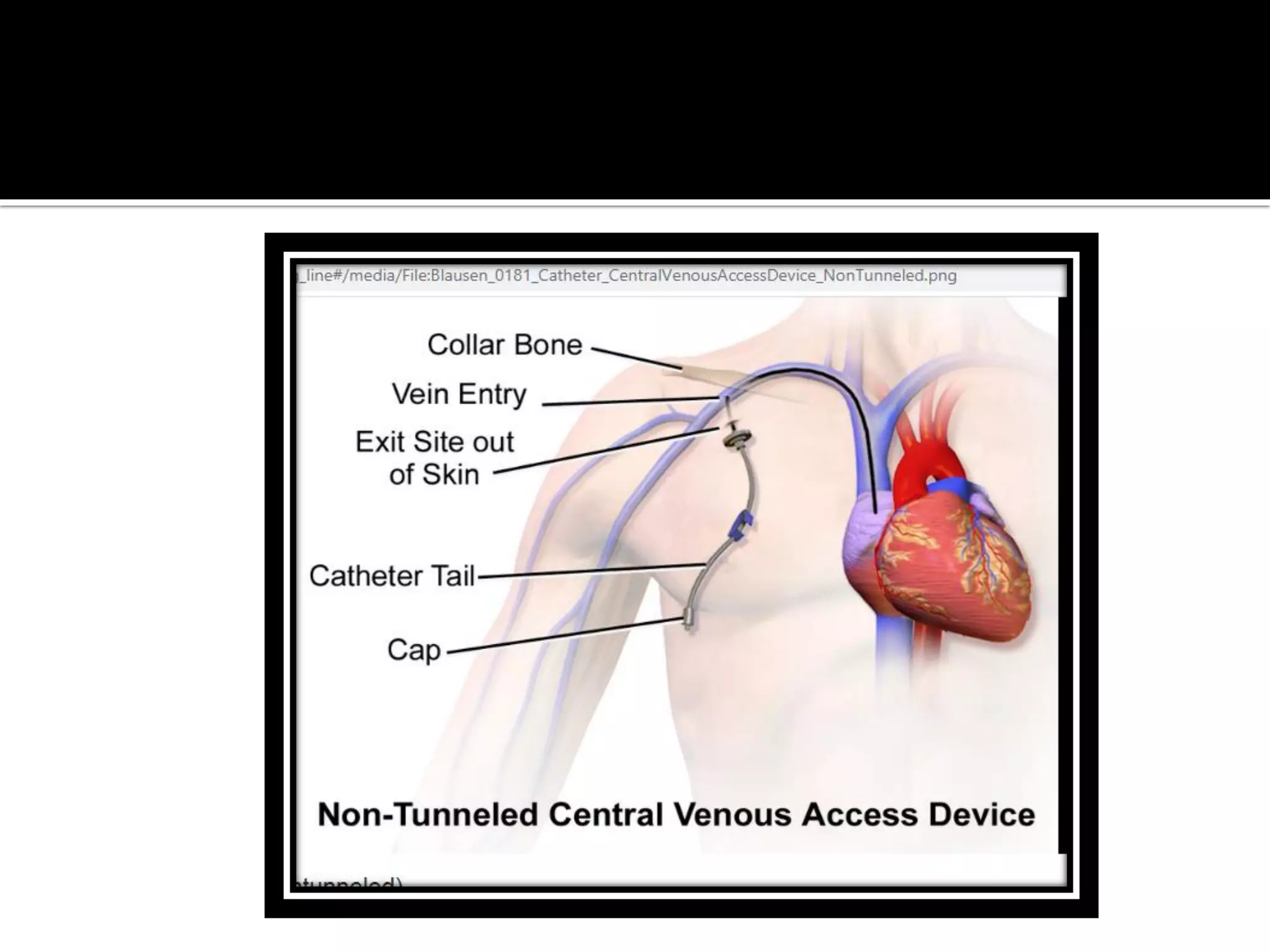 central venous catheter | PDF