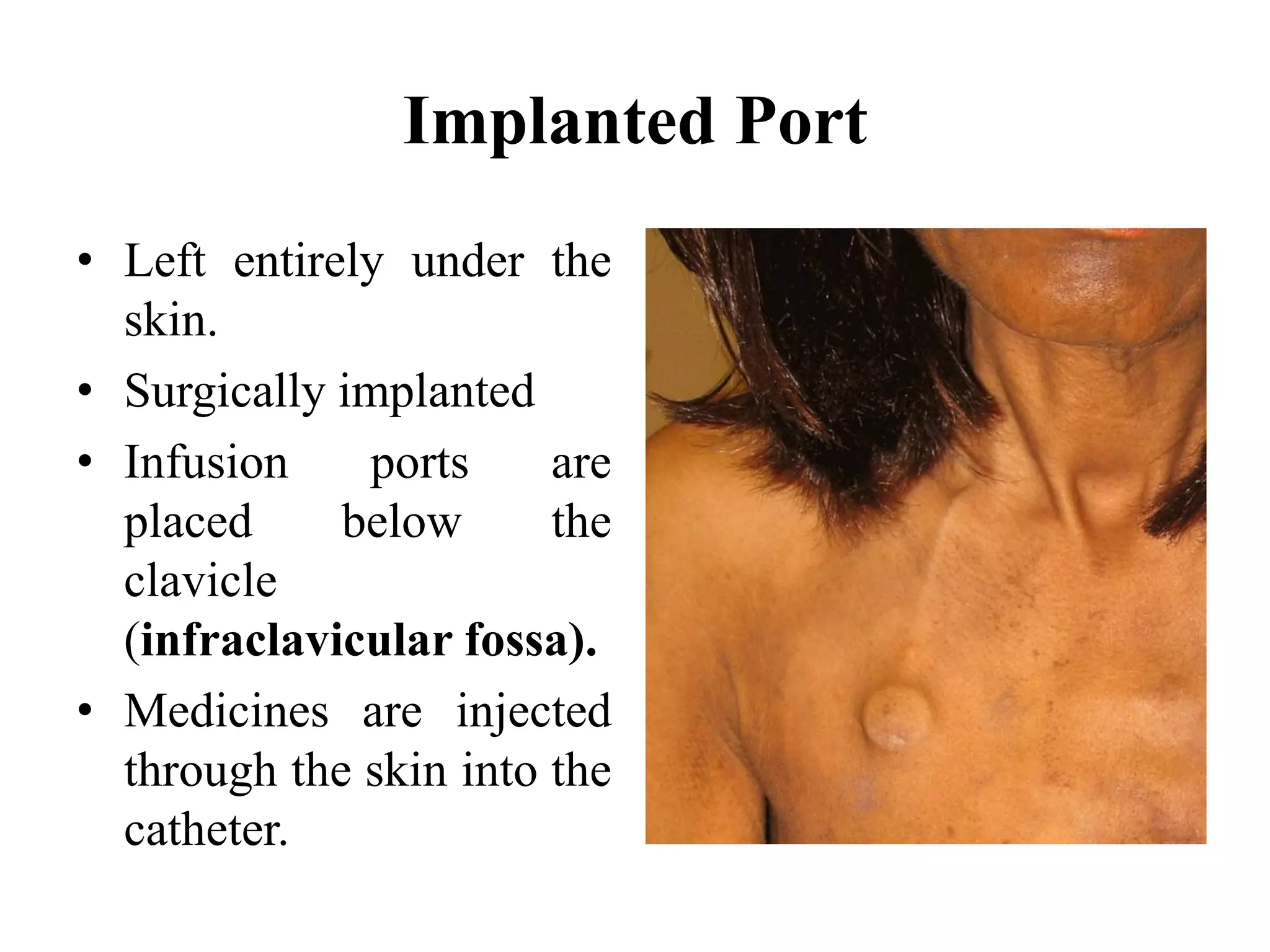 Central Venous Catheter Care- A Nursing skill | PDF