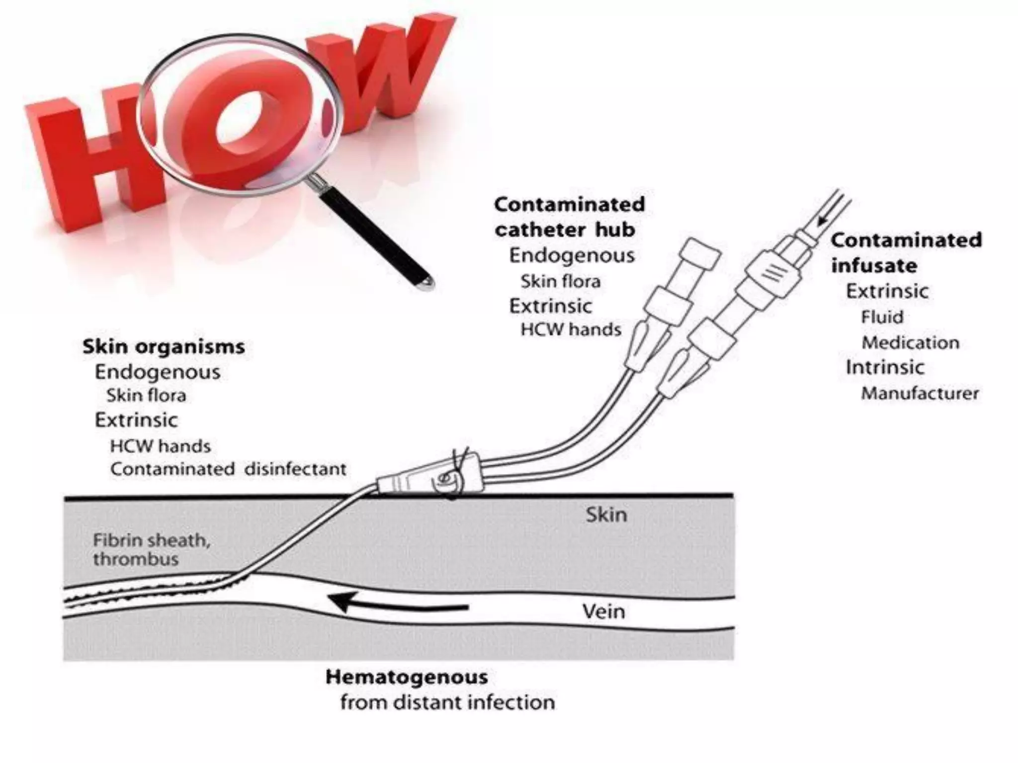 Central Venous Catheter Care- A Nursing skill | PDF