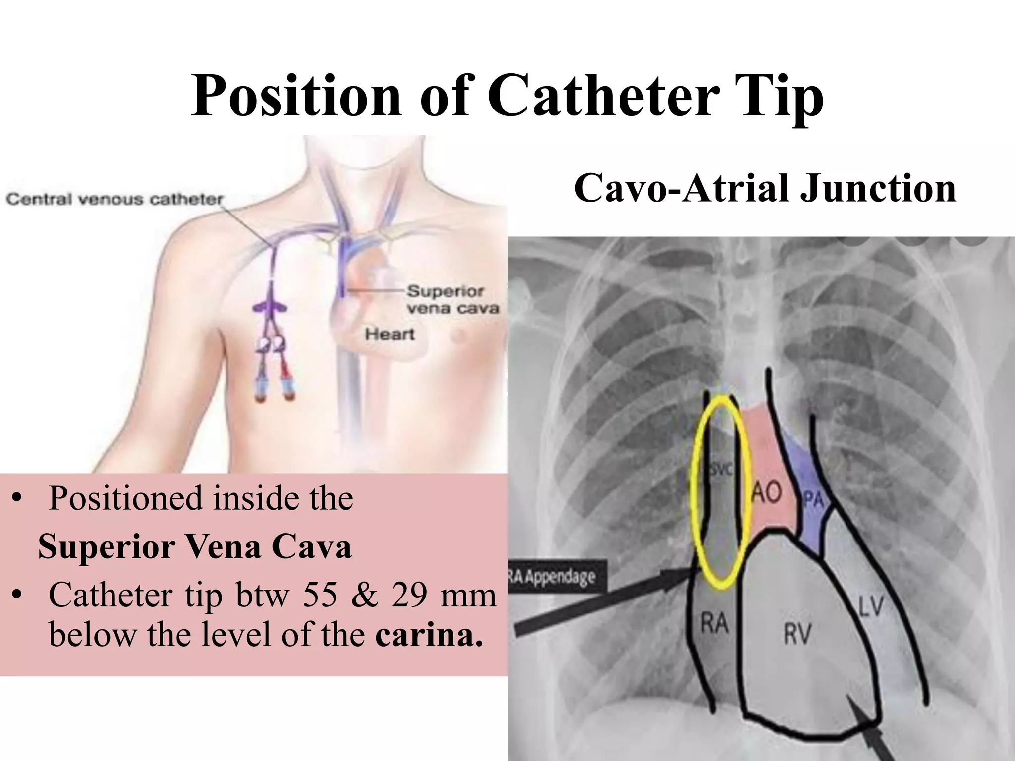 Central Venous Catheter Care- A Nursing skill | PDF